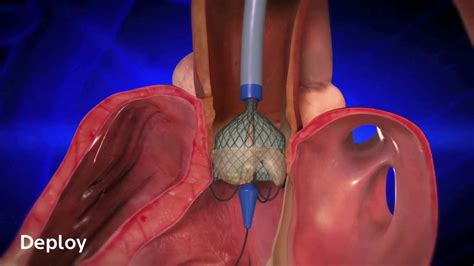 The Tavr Procedure Deployment On Vimeo