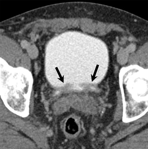 Urinary Bladder Masses Rare Subtypes And Masslike Lesions Radiologic