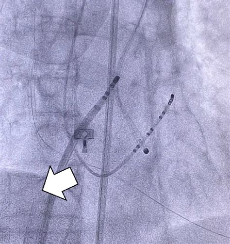 Radiographic Image Of The Ecmo Inflow Cannula Ecmo Extracorporeal Download Scientific Diagram