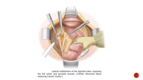 Abdominoperineal Resectionpptx