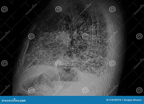 X Ray Image Multiple Small Bilateral Nodular Lesions And Spiculated