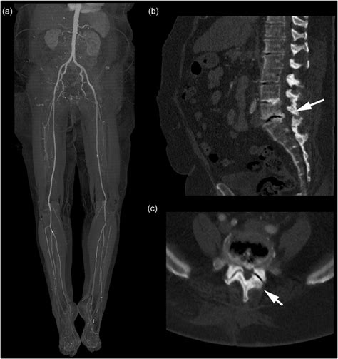 Example Of A Patient Presenting With Intermittent Claudication The Download Scientific Diagram