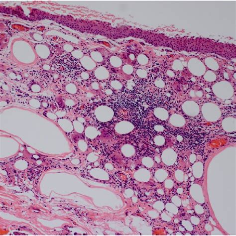A The Slit Lamp Photograph Shows A Salmon Patch Lesion On The Temporal