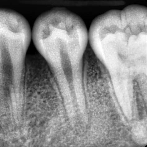 Pdf Case Revascularization Of An Immature Necrotic Permanent
