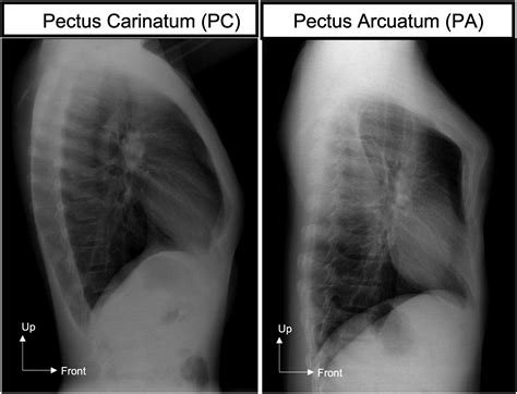Pectus Arcuatum A Pectus Unlike Any Other Journal Of Pediatric Surgery