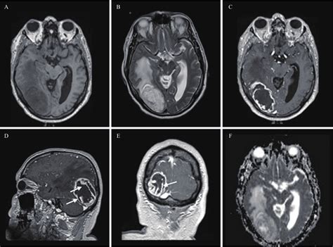 Angiosarcomatous Component In Gliosarcoma Case Report And Consideration Of Diagnostic Challenge