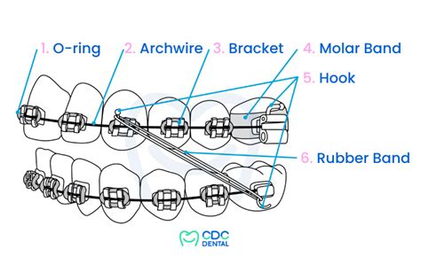 Metal Braces In Thailand Premium Care Local Price