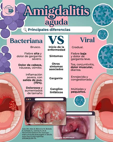 Imágenes De Faringitis Estreptocócica Viral Fotos De Amigdalitis Y