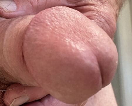 Hypospadias Cock Pics XHamster