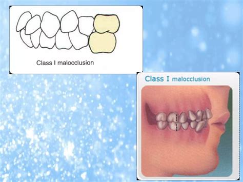 Angles Classification Of Malocclusion Pptx