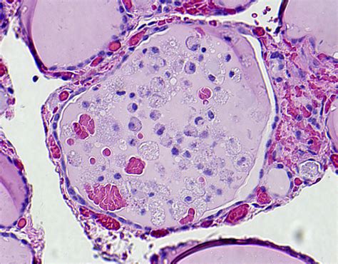 Thyroid Nodule Pathology