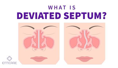 Septum Infection Symptoms Bacterial Nasal Infections Aqny