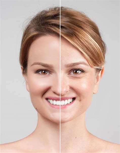 Botulinum Toxin Aspect