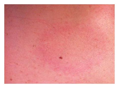 Five Cm Erythematous Macular Rash With Central Clearing On The