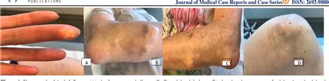 Figure 1 From Cutaneous Calcinosis In Limited Cutaneous Systemic