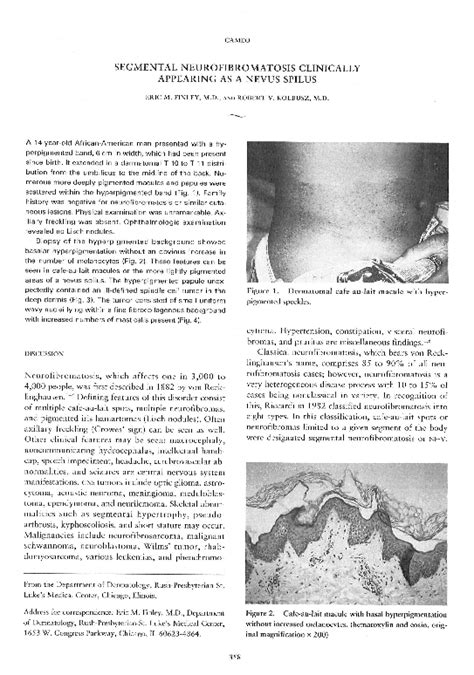 Pdf Segmental Neurofibromatosis Clinically Appearing As A Nevus Spilus Robert Kolbusz