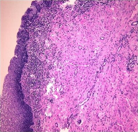 Areas Covered By Columnar Non Ciliated Epithelium Containing Mucinous Download Scientific