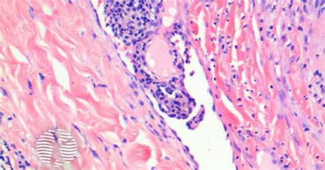 Kaposi Sarcoma Pathology Image