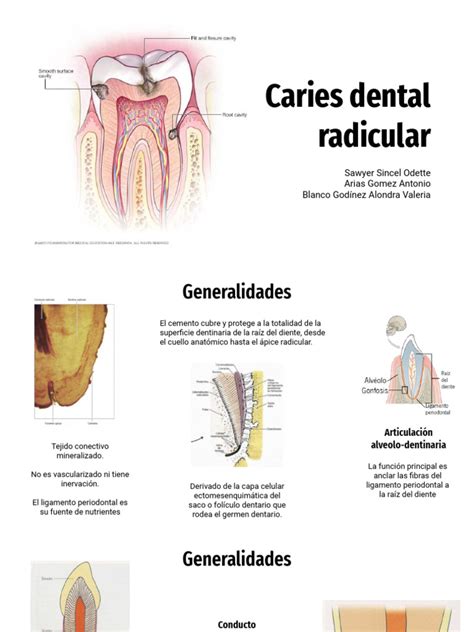 Caries Dental Radicular Pdf Diente Esmalte De Dientes