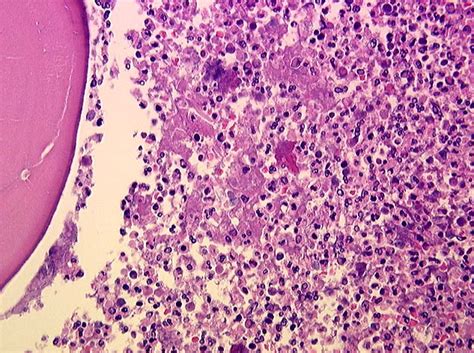 Gram Negative Rods In Clusters