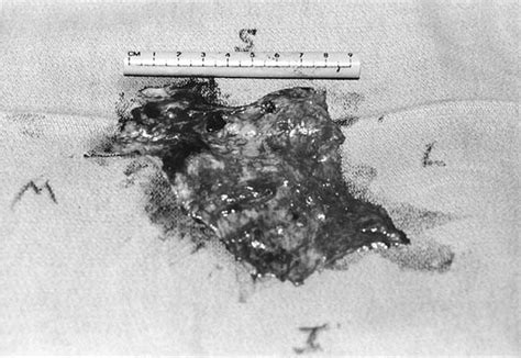 Scapulothoracic Bursectomy For Snapping Scapula Syndrome Journal Of Shoulder And Elbow Surgery