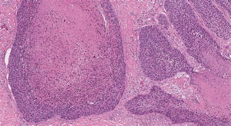 Hpv Associated Squamous Cell Carcinoma In The Oral Cavity Atlas Of Pathology