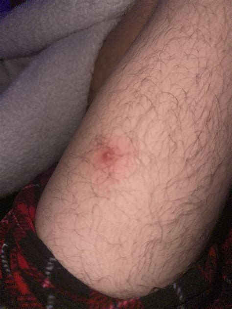 Is This A Tic Bite Rforestry