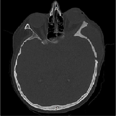 Virtual Step Stealth Neuronavigation Guided Simulated Craniotomy Download Scientific Diagram