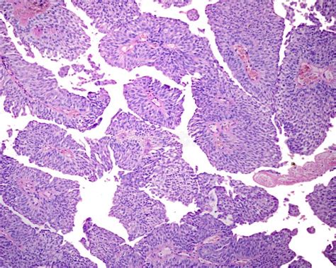 Human Urinary Bladder Papillary Carcinoma Stock Image Image Of Human