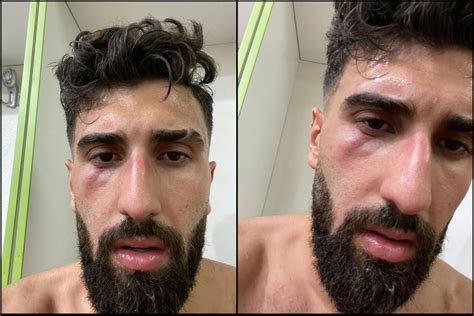 کبودی عجیب صورت هافبک سابق پرسپولیس عکس مهگل نیوز Mahgol