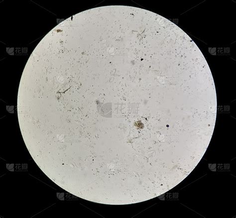 尿镜40x显示大量脓液细胞，少量上皮细胞。显微照片