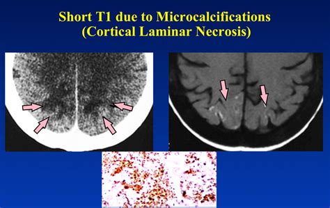 Short T1 Calcification Questions And Answers In Mri