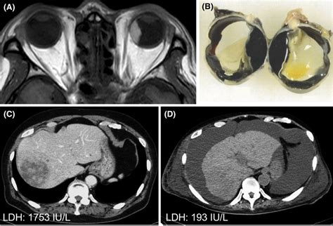 A Magnetic Resonance Imaging On T1w1 Shows A 16 × 12 × 17‐mm Tumor Download Scientific Diagram
