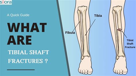 What Are Tibial Shaft Fractures A Quick Guide Orthopedic Implant
