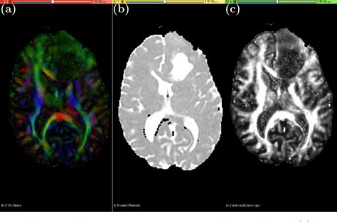 Figure 1 From Tumor Ablation Due To Inhomogeneous Anisotropic