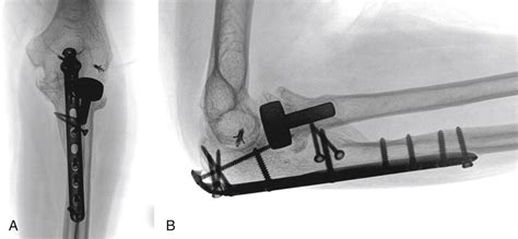 Fractures Of The Proximal Ulna Clinical Tree