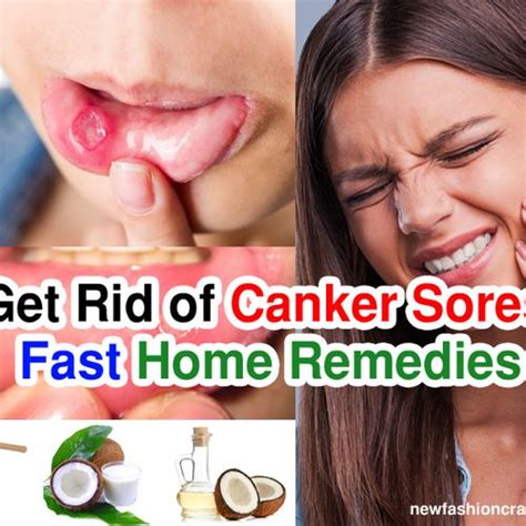 How To Get Rid Of Canker Sores Fast Home Remedies 8 Tips Canker Sore Cankers Soreness