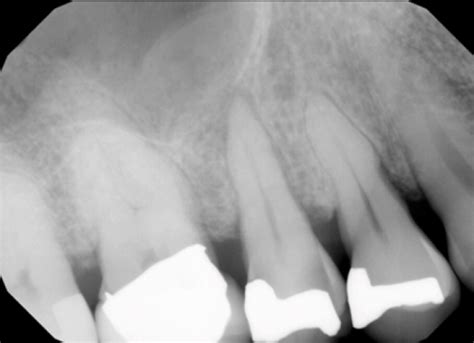 Sinus Augmentation Without Membrane Exposure A Safer Approach