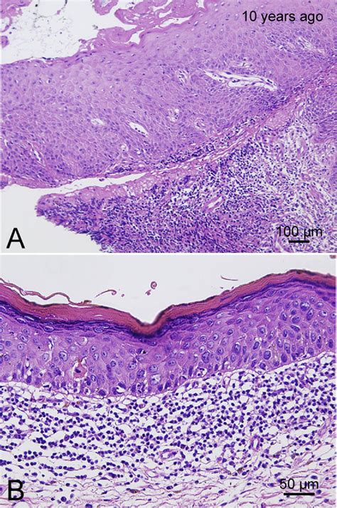 Penile Carcinoma Originating From Lichen Planus On Glans Penis Urology
