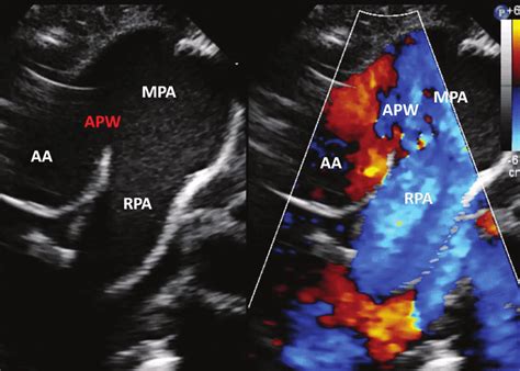 Transthoracic Echocardiography With Colour Compare In Parasternal Short Download Scientific