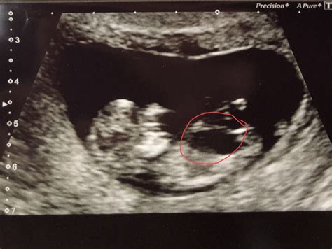 Enlarged Bladder Mumsnet