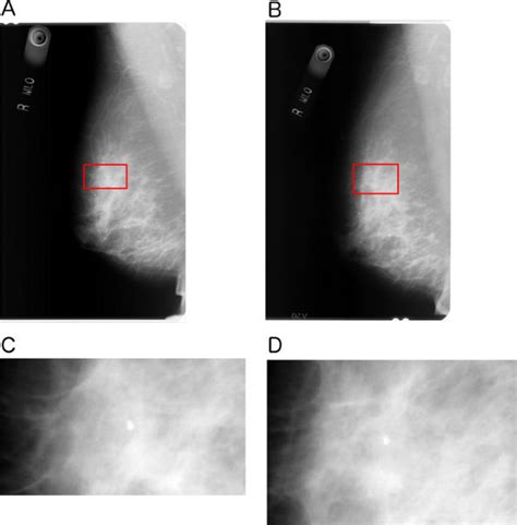 Detection Of Architectural Distortion In Prior Mammograms Via Analysis Of Oriented Patterns