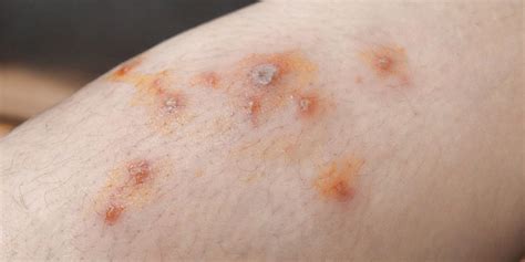Impetigo Symptoms Causes Prevention And Treatment