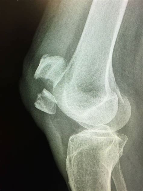 Hairline Fracture Kneecap At Kevin Turner Blog