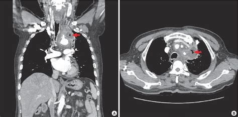 Figure 2 From Descending Necrotizing Mediastinitis After A Trigger Point Injection Semantic