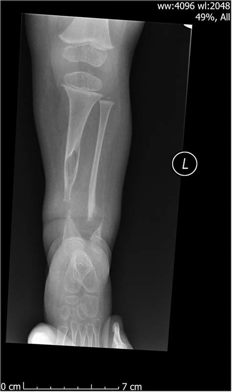 Pseudoartrose Tibial Pseudarthrose Der Tibia Versuch Der Heilung