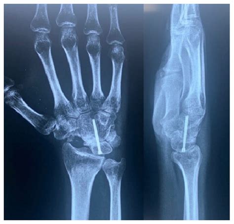 Post Operative X Ray Download Scientific Diagram