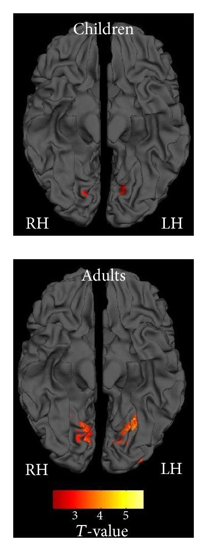 Research Paper Splenium Of Corpus Callosum Patterns Of Interhemispheric Interaction In