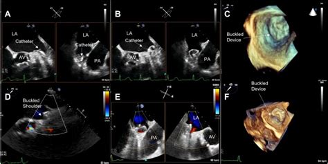 American Society Of Echocardiography On Linkedin Left Atrial Appendage Occlusion Device