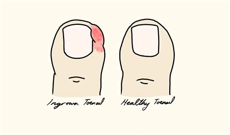 Ingrown Toenail Treatment Foot Hq Atelier Yuwaciaojp